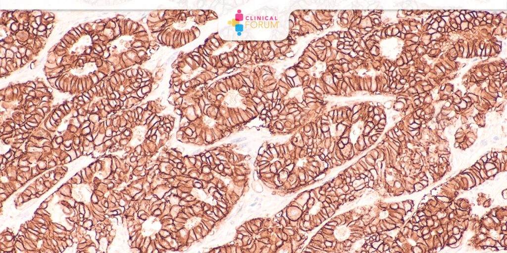 The HER Family: A Pan Tumor Approach: A Clinical Forum℠ - RMEI